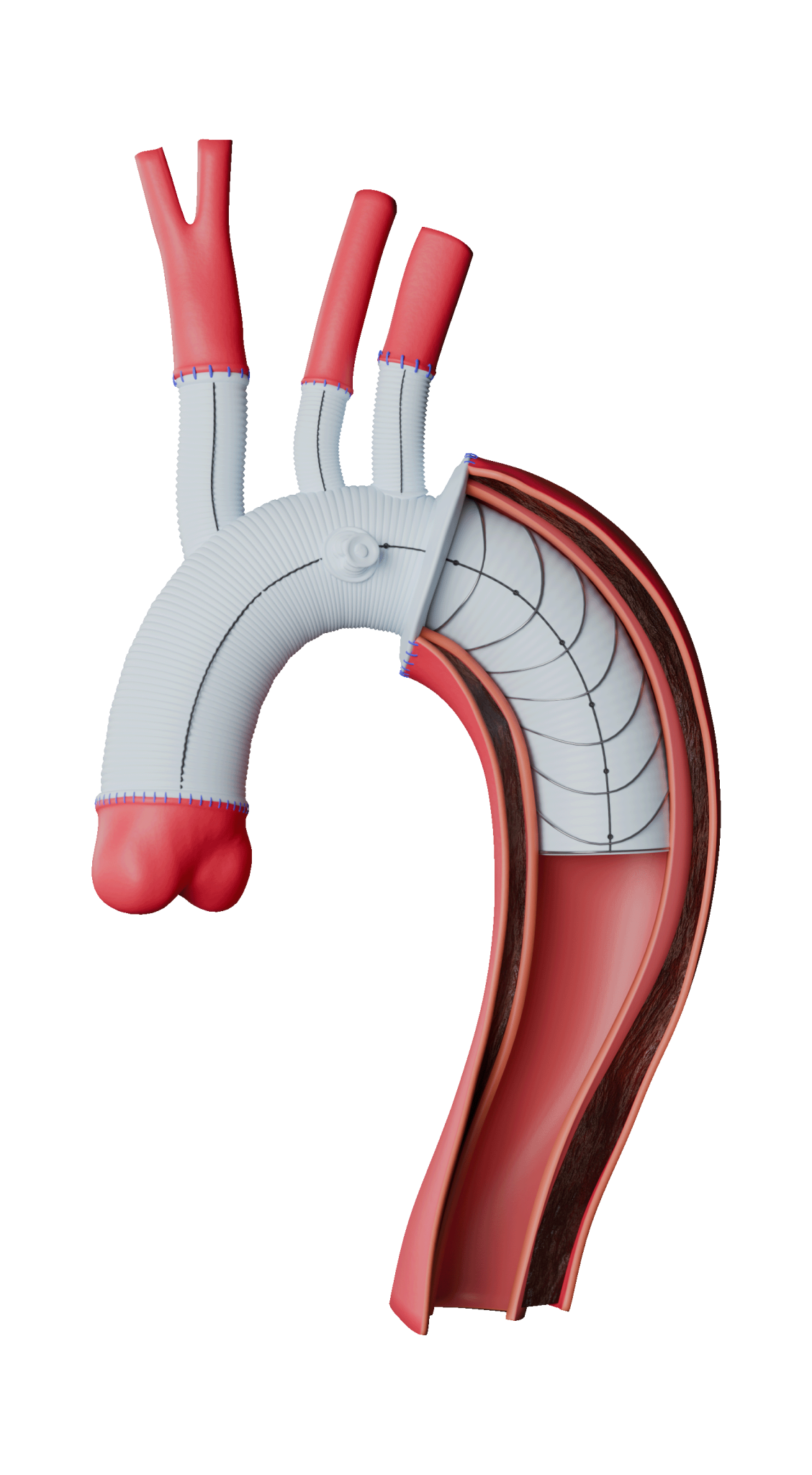 Thoraflex Hybrid | Conforming Aortic Arch Surgery to the Gold Standard