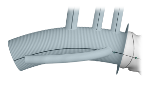 Thoraflex Hybrid | Conforming Aortic Arch Surgery to the Gold Standard