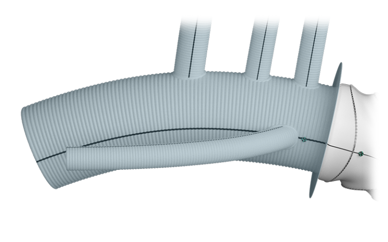 Thoraflex Hybrid | Conforming Aortic Arch Surgery to the Gold Standard