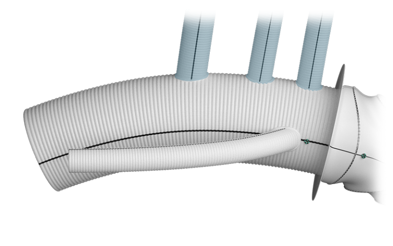 Thoraflex Hybrid | Conforming Aortic Arch Surgery to the Gold Standard