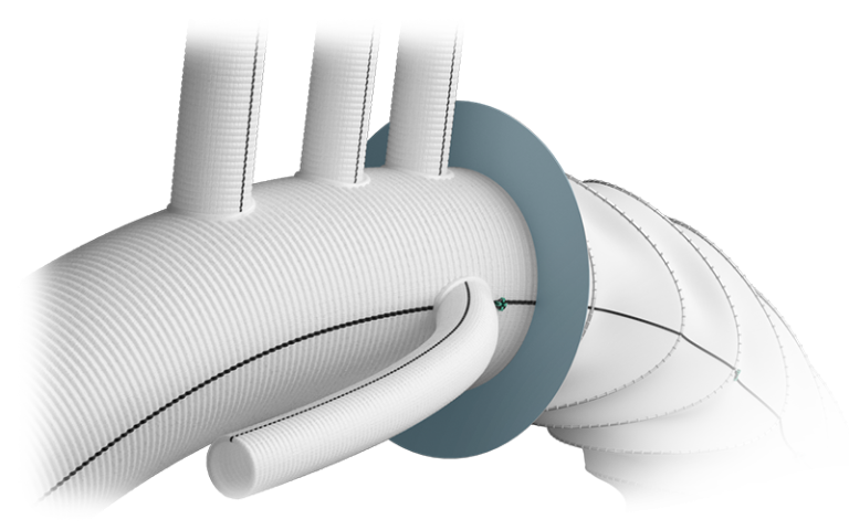 Thoraflex Hybrid | Conforming Aortic Arch Surgery to the Gold Standard