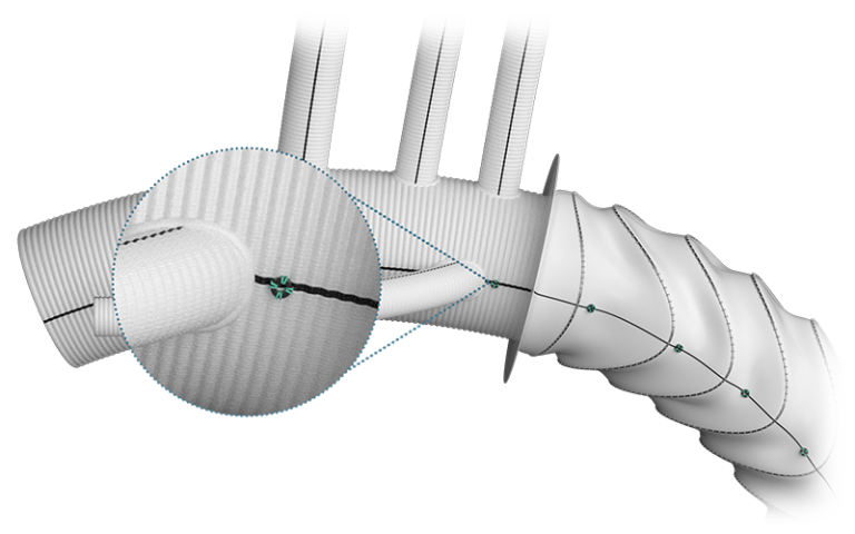 Thoraflex Hybrid | Conforming Aortic Arch Surgery to the Gold Standard