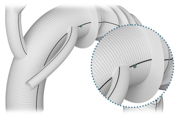 Custom Thoraflex Hybrid | Terumo Aortic