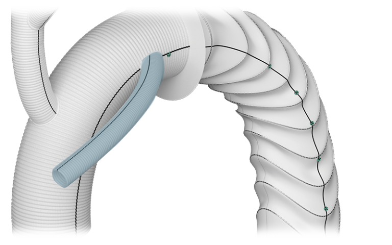 Custom Thoraflex Hybrid | Terumo Aortic