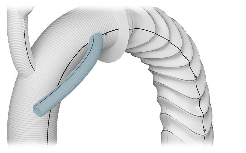 Custom Thoraflex Hybrid | Terumo Aortic