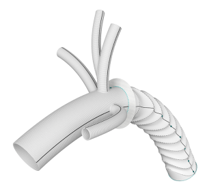 Custom Thoraflex Hybrid | Terumo Aortic