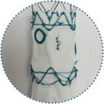 Fenestrated TREO | Advancing Fenestrated Horizons