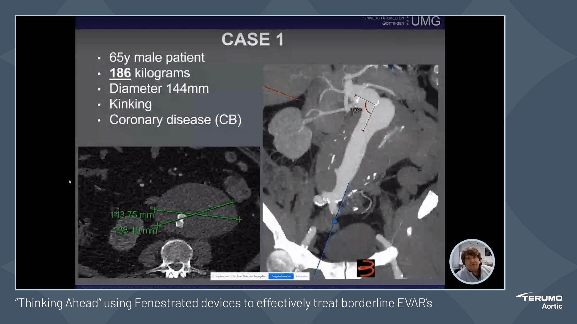 Thinking ahead: using FEVAR in complex & borderline EVAR repair ...
