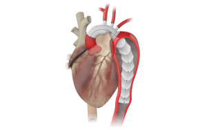 Thoraflex Hybrid | Terumo Aortic