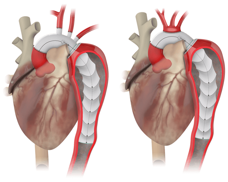 Thoraflex™ Hybrid | Terumo Aortic