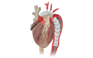 Thoraflex™ Hybrid | Terumo Aortic