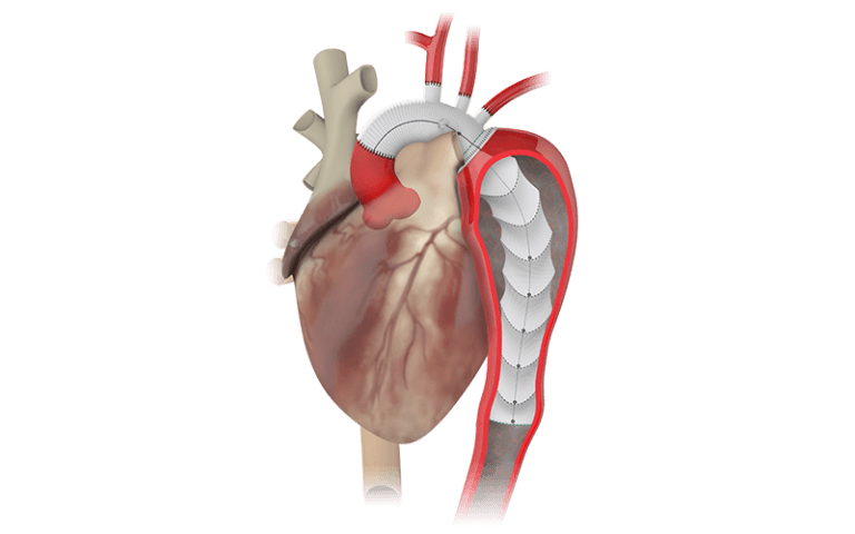 Thoraflex™ Hybrid | Terumo Aortic