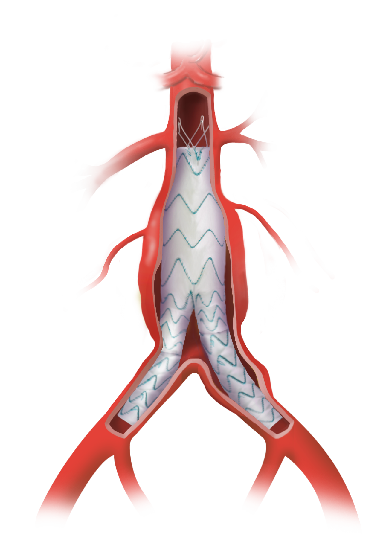 Charing Cross Terumo Aortic