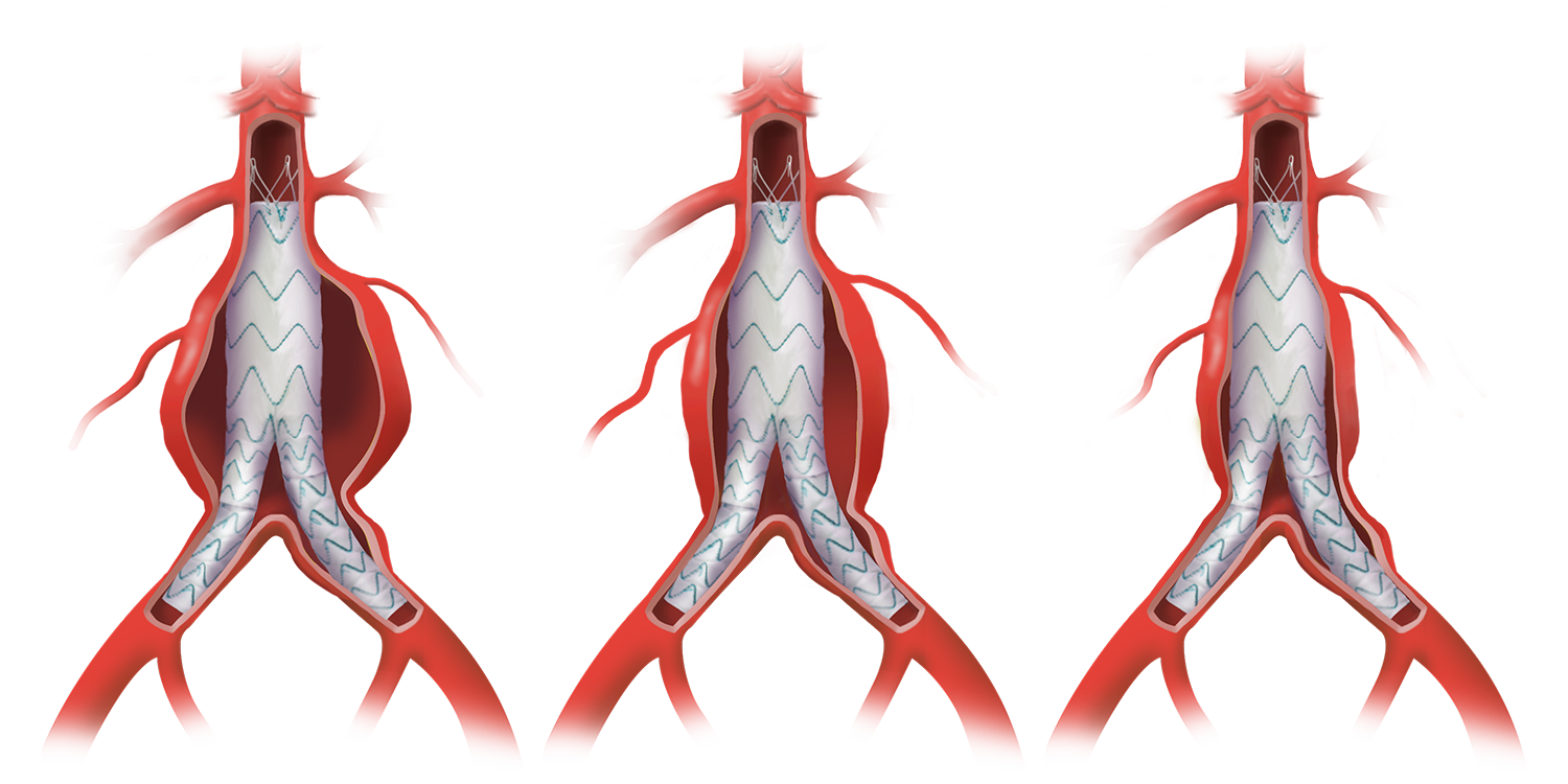 TREO | Versatile by Design. Fit for any Anatomy.*