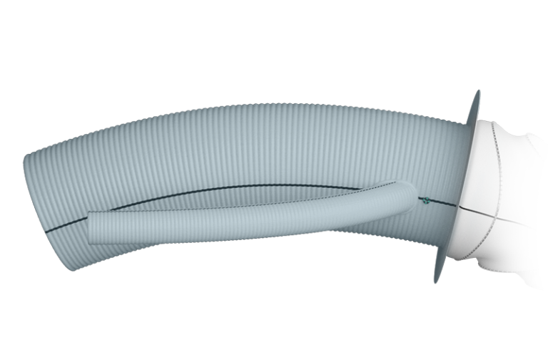 Thoraflex Hybrid | Conforming Aortic Arch Surgery to the Gold Standard