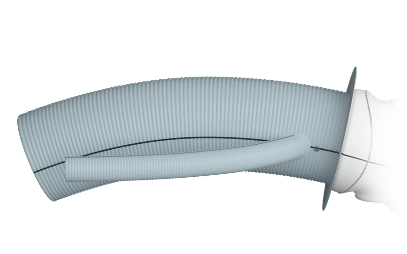 Thoraflex Hybrid | Conforming Aortic Arch Surgery to the Gold Standard