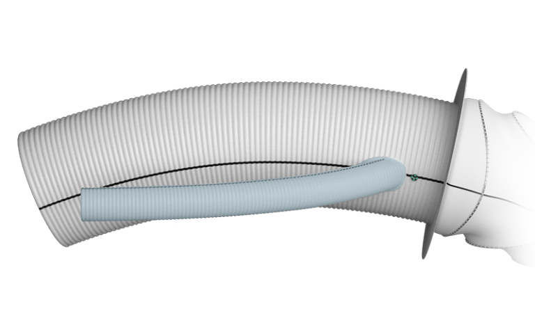 Thoraflex Hybrid | Conforming Aortic Arch Surgery to the Gold Standard