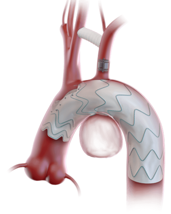 Relay Multi Feature | Terumo Aortic